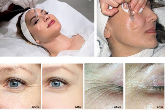 Water Oxygen Facial Jet Peel Machine Skin Rejuvenate