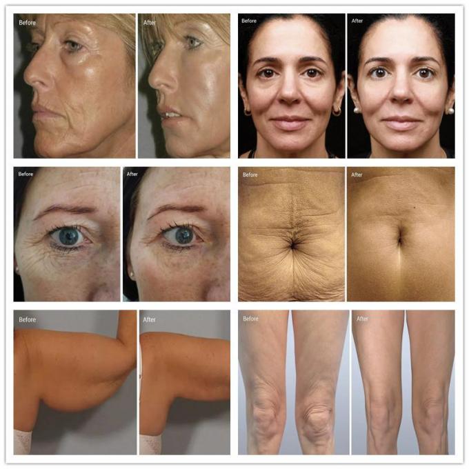 Skin Tightening AC110V 60Hz 1.2MHz Radio Frequency Machine