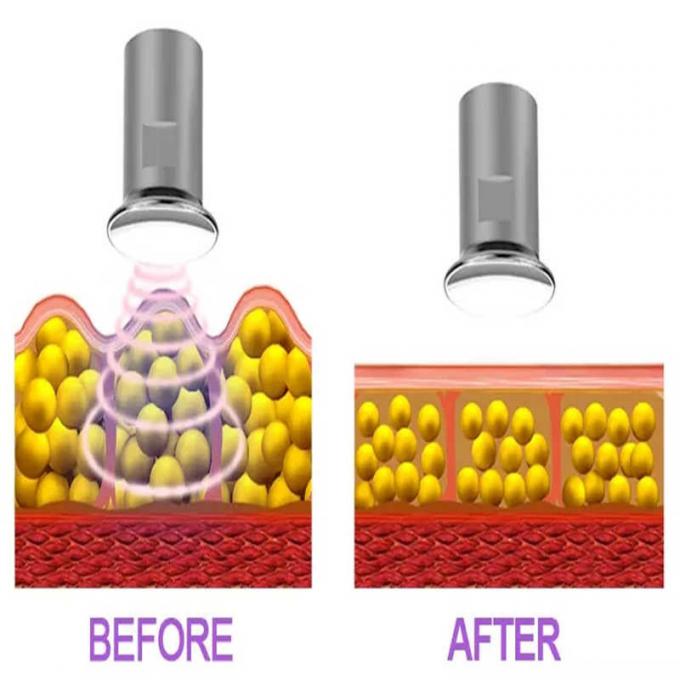 Pain Points Hitting Air Pressure Shock Wave Machine Pain Relief ...